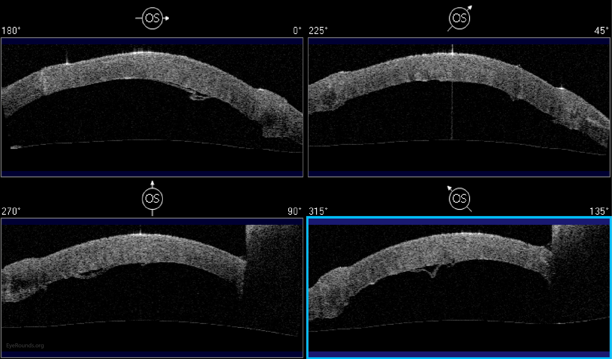Deep Anterior Lamellar Keratoplasty (DALK)